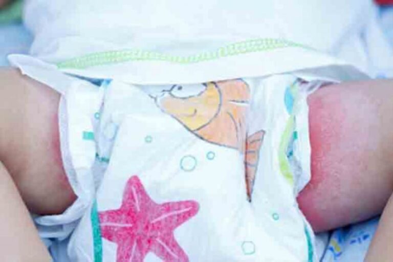 Soothing the Sting: Guide to Treating Bad Diaper Rash - Pro Baby Guide